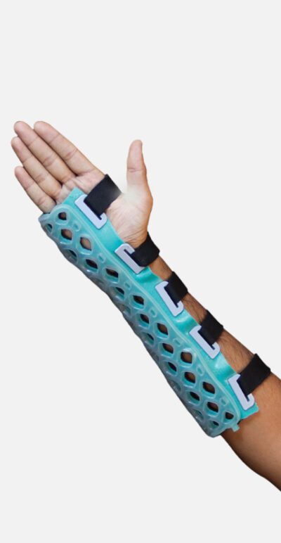 Splint or Slab - OrthoHeal